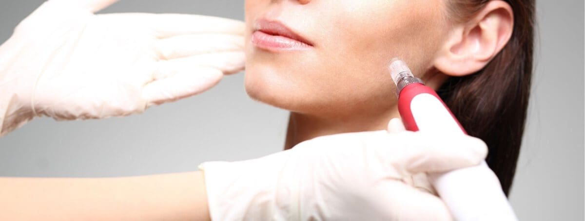 What are the Benefits of Microneedling Treatment?