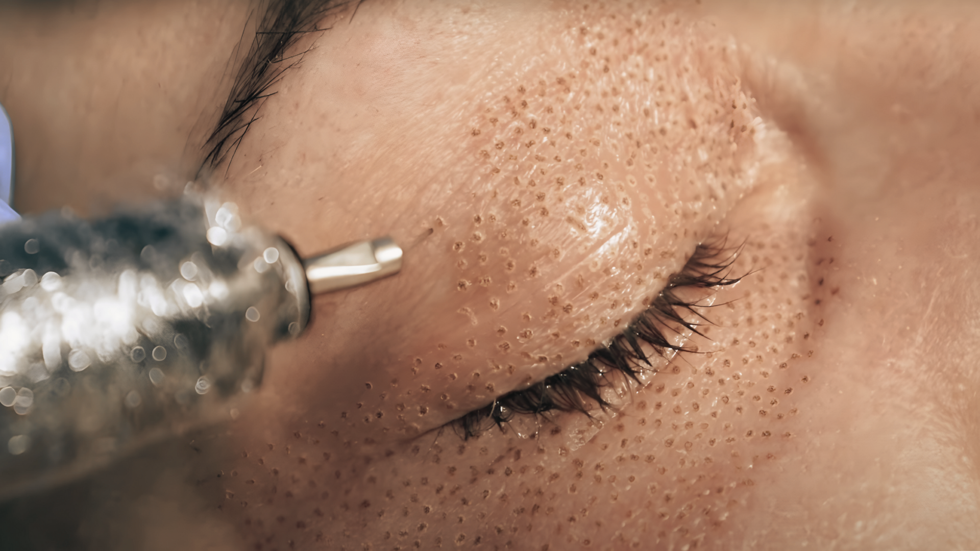 What is Plasma Pen Fibroblast? What are its Benefits?