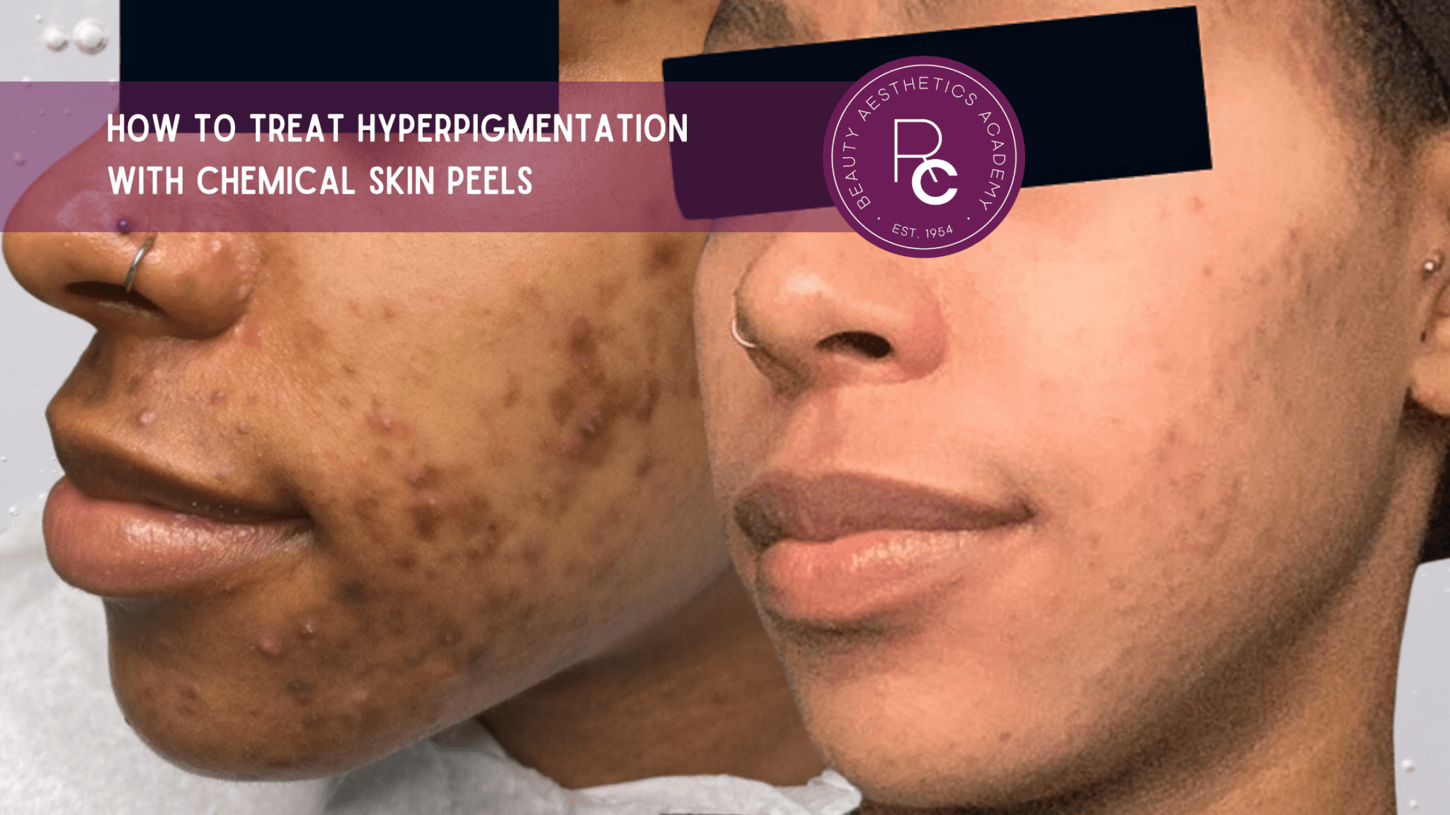 How to Treat Hyperpigmentation with Chemical Skin Peels