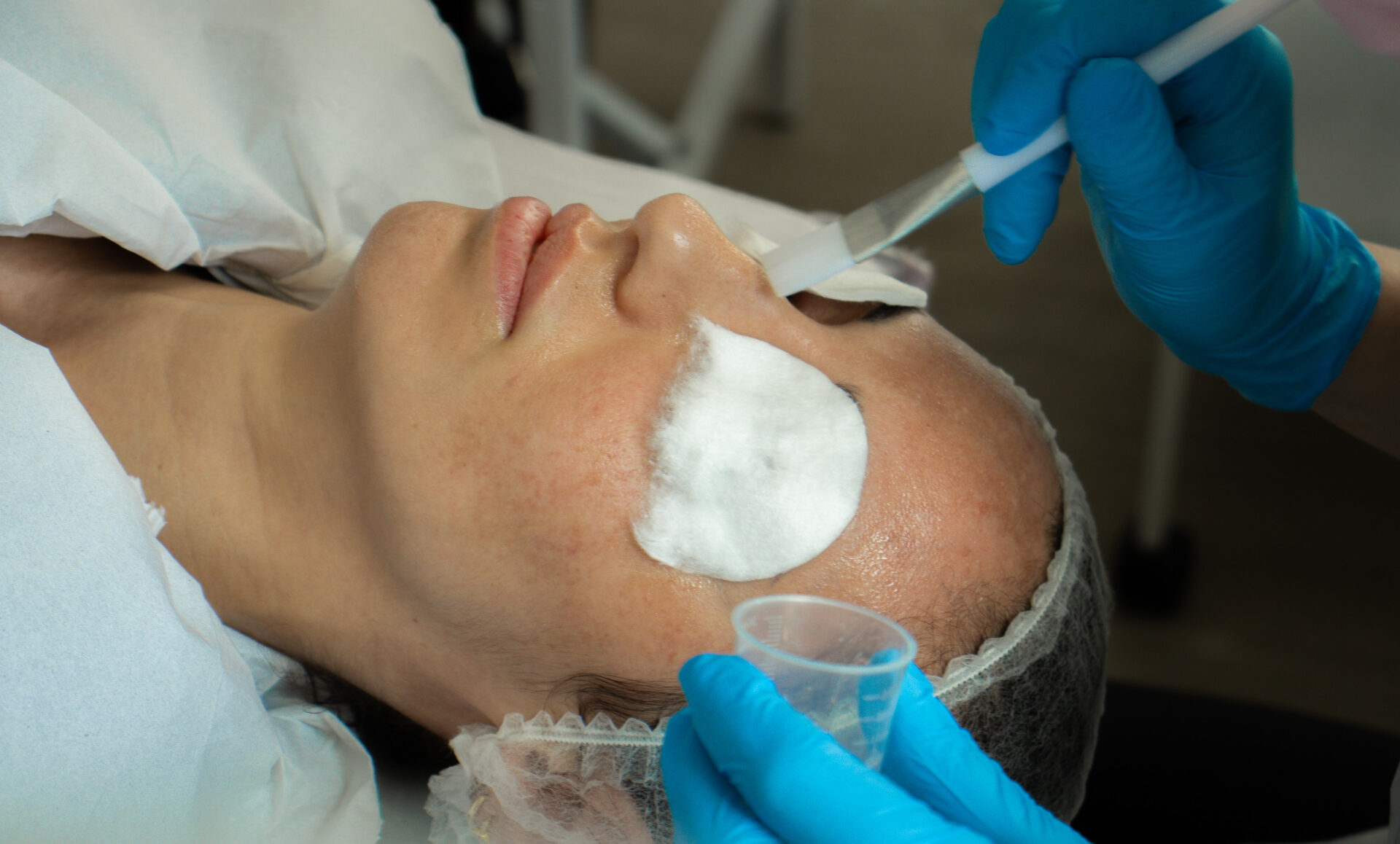 How to Treat Hyperpigmentation with Chemical Skin Peels