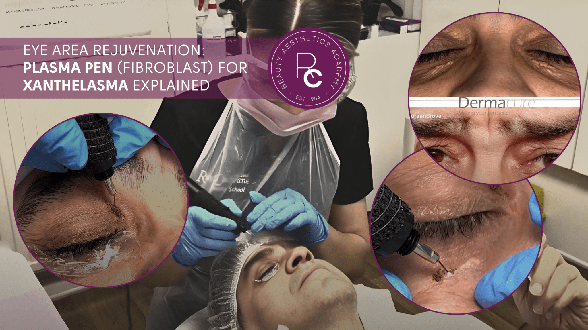 Eye Area Rejuvenation: Plasma Pen (Fibroblast) for Xanthelasma